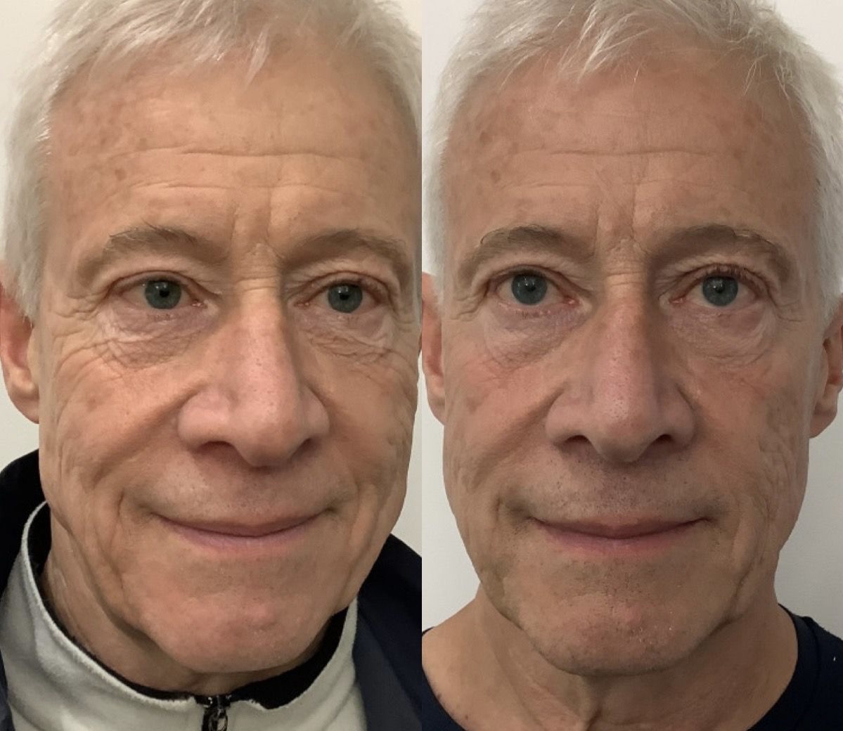 Aged Skin – Pulse Laser